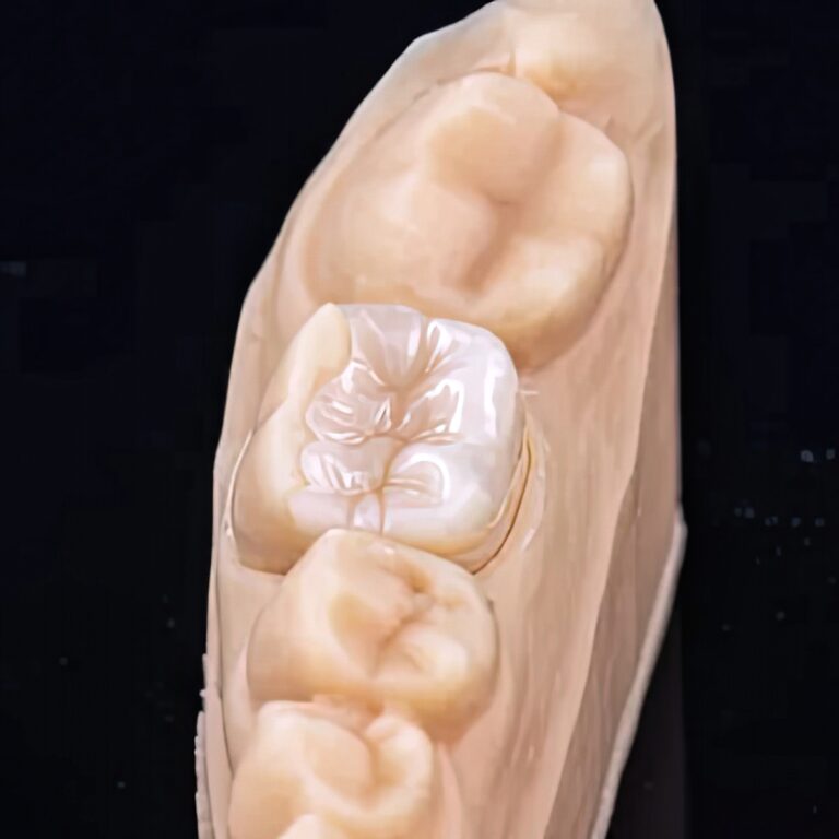 Indirect Composite: A Great Restorative Option