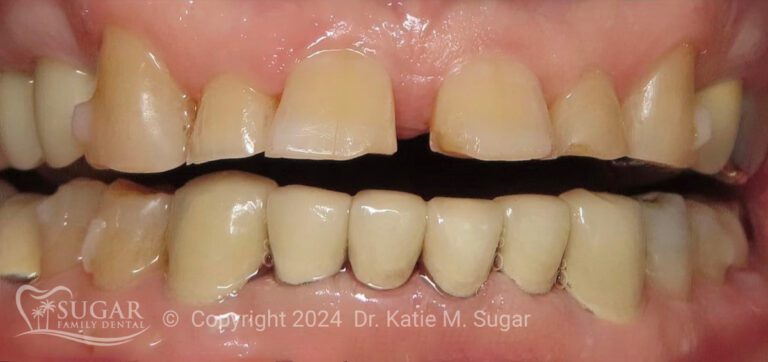 Optimized Treatment Planning: A Case Study With E.max Restorations ...