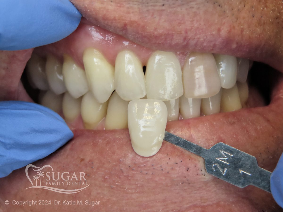 Masking An Endodontically Treated Tooth