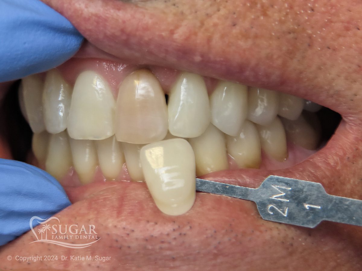Masking An Endodontically Treated Tooth