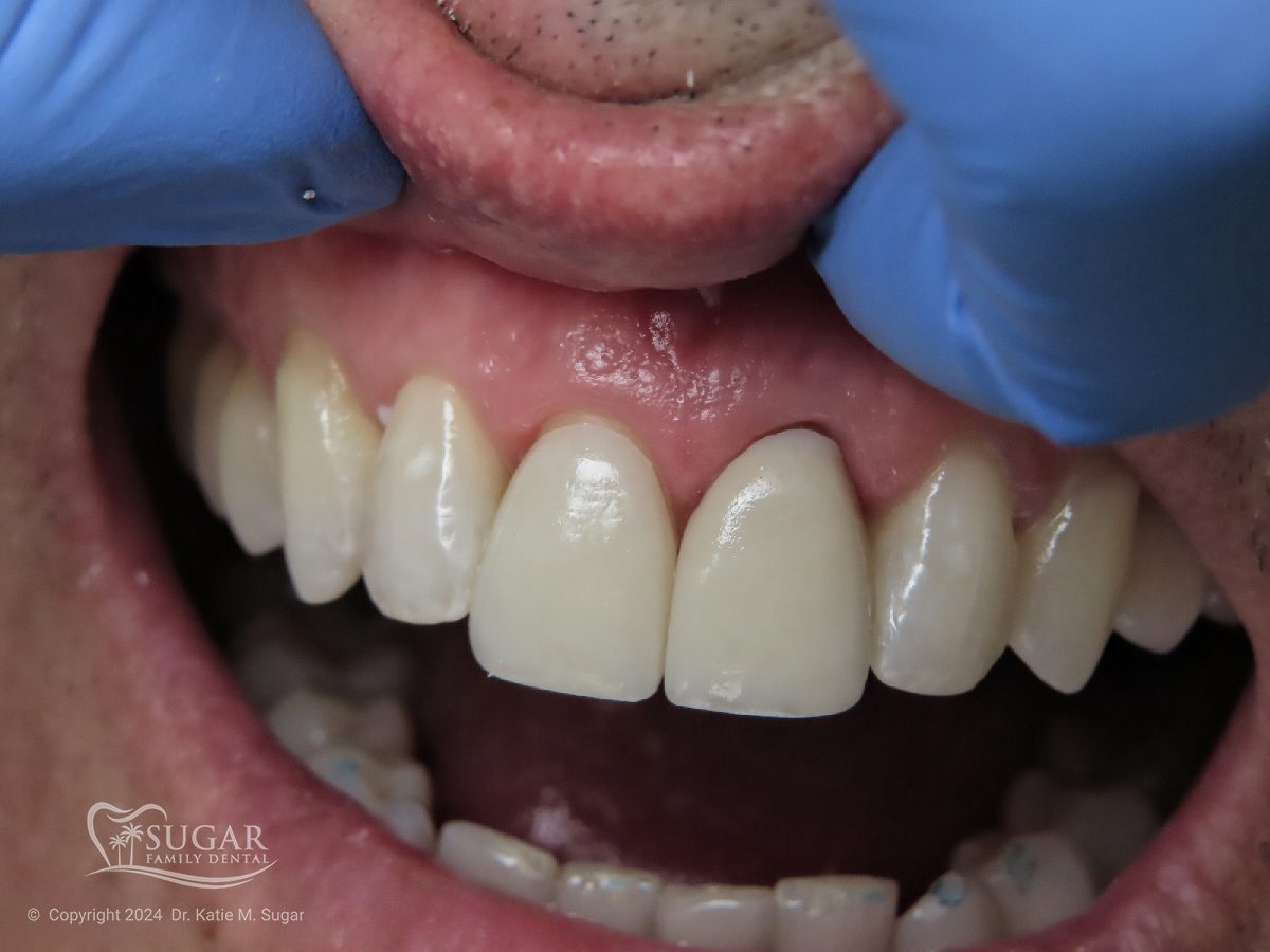 Masking An Endodontically Treated Tooth