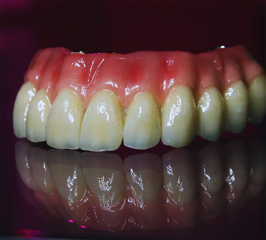 The All On X Revolution: Transforming Dental Practices Through ...