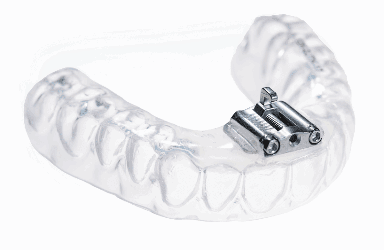 TAP 3 Device For Treatment Of Sleep Apnea - Burbank Dental Lab