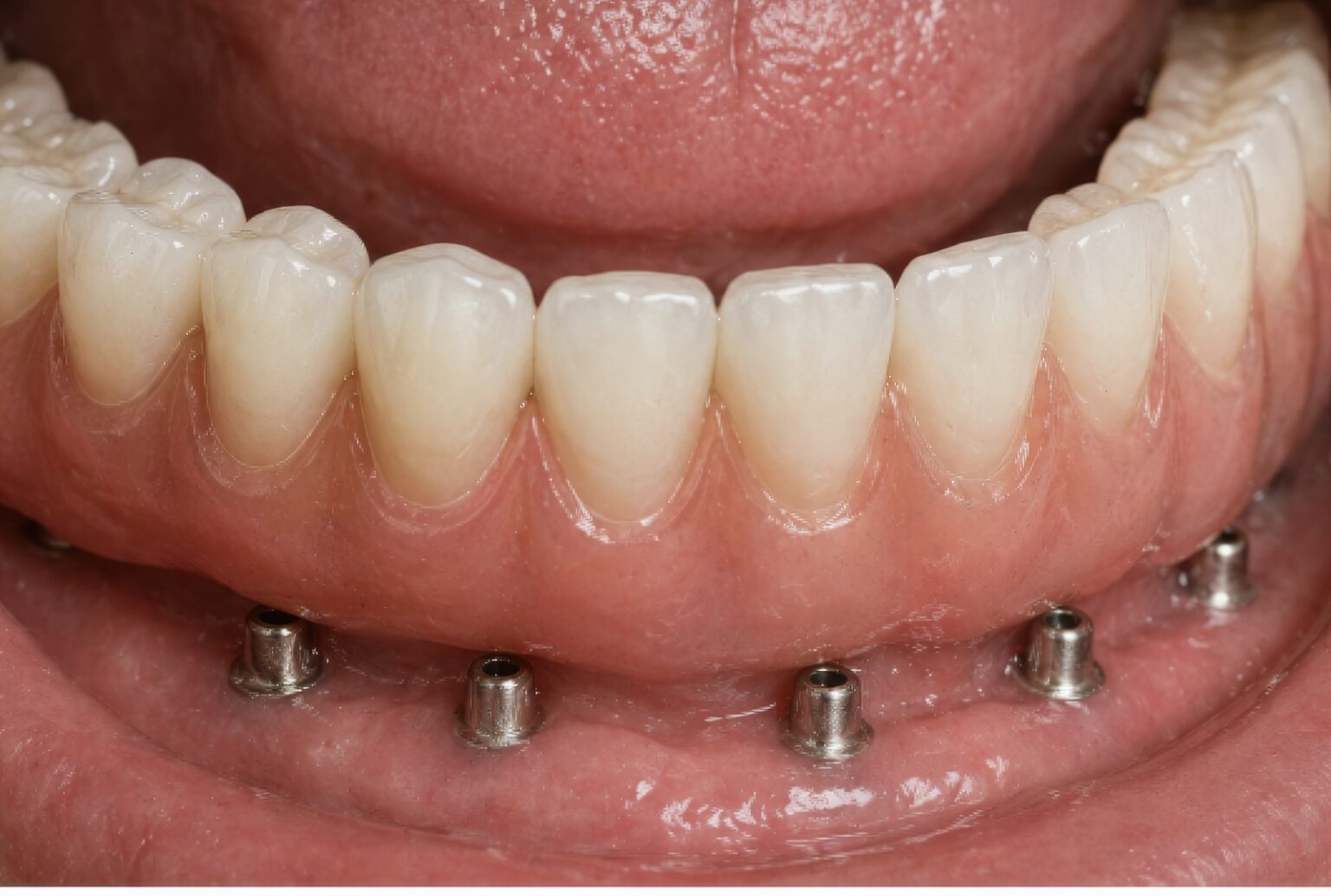 Choosing The Right Full-Arch Implant Restoration: Hybrid, Zirconia ...