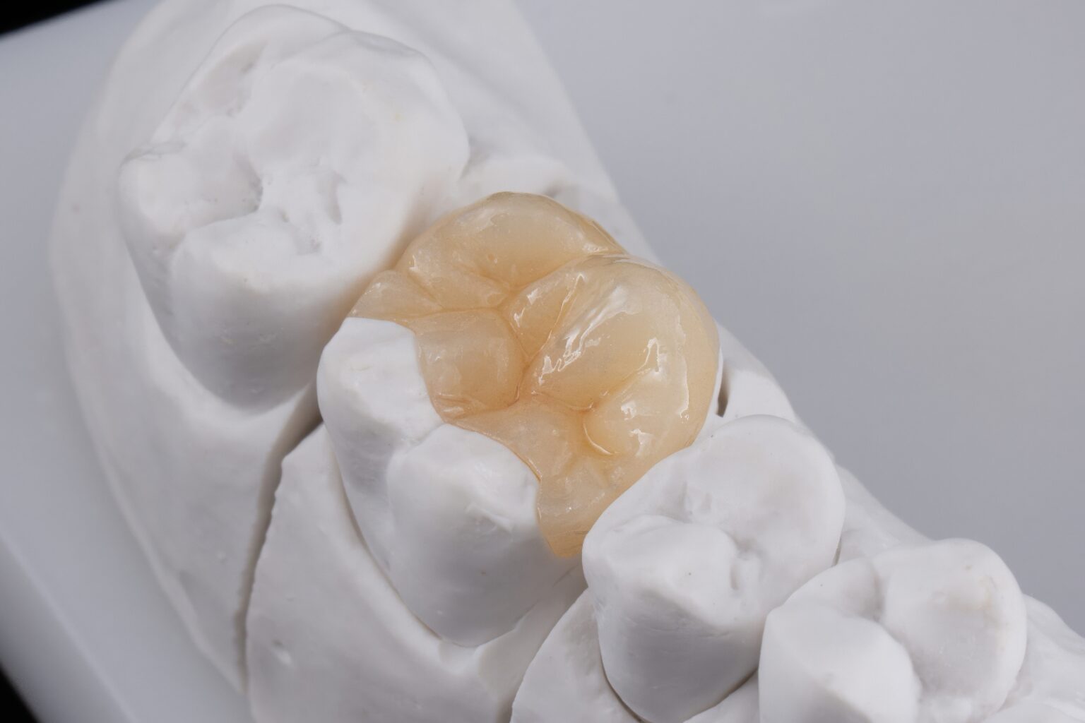 Composite Restoration - Burbank Dental Lab
