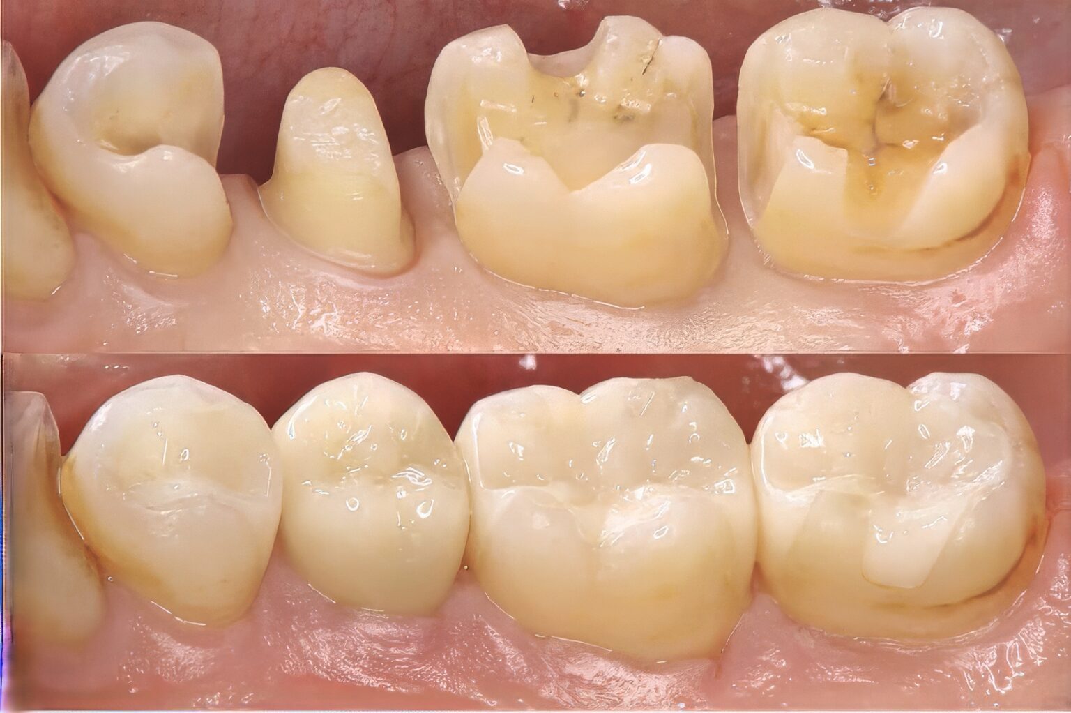 Composite Restoration - Burbank Dental Lab